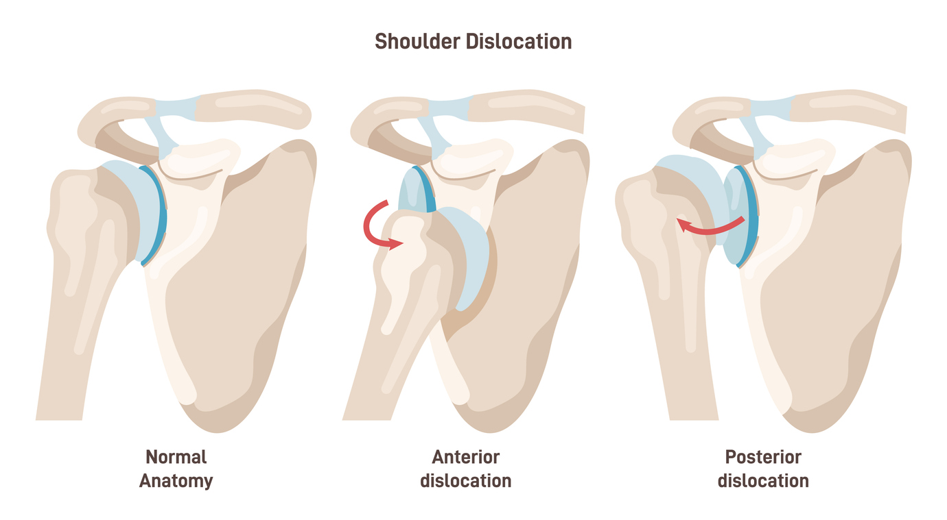 Shoulder Instability Chicago | Shoulder Pain Chicago | Shoulder ...