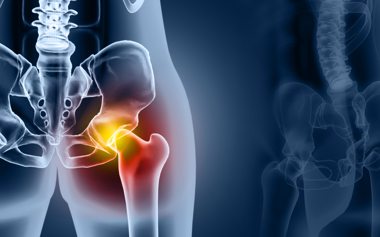 Hip Osteoarthritis Chicago IL | Hip Pain Chicago IL | Hip Replacement ...